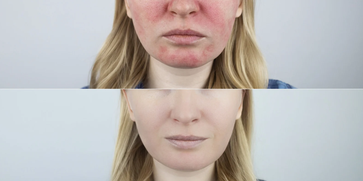 What Does Menopause Rosacea Look Like: Photos & Examples – Lubracil