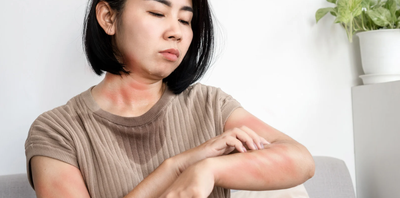 Menopause Rash and Hives: Causes and Relief – Lubracil
