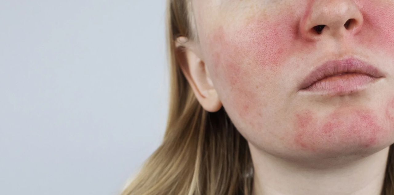 What Is The Connection Between Rosacea And Menopause? – Lubracil