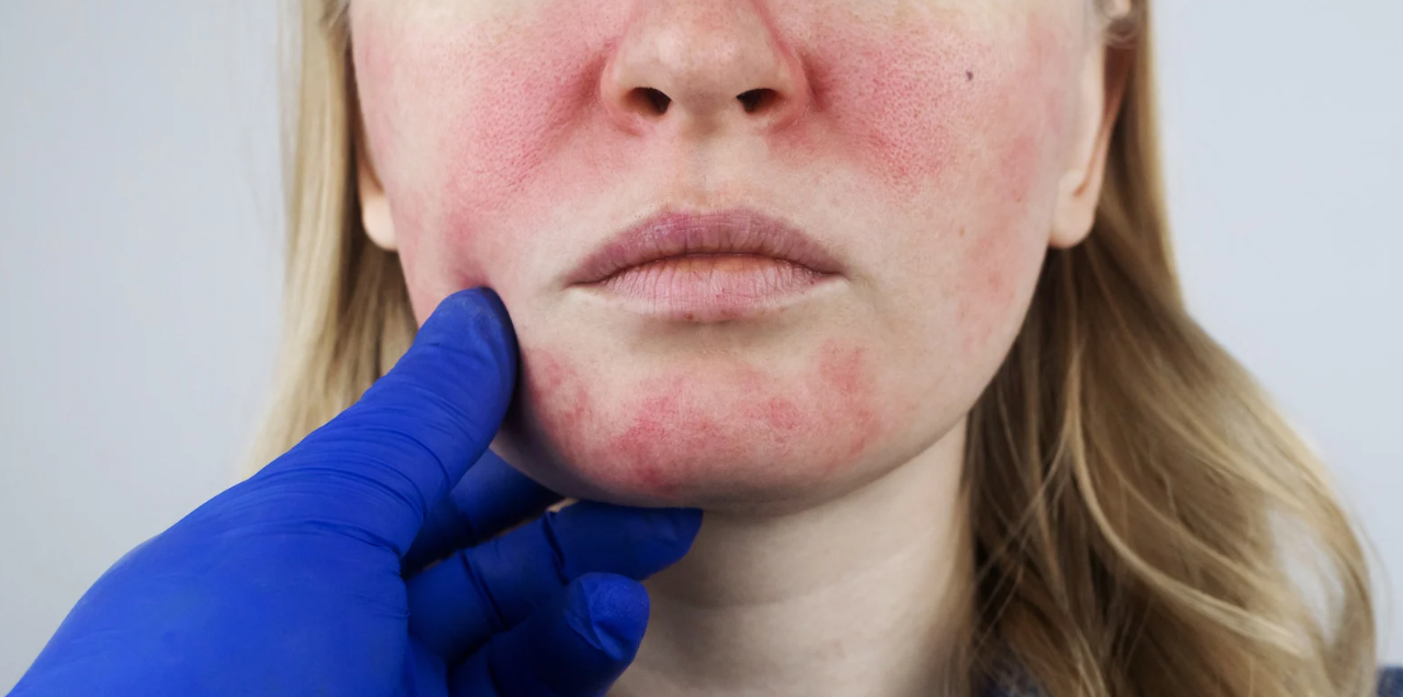 Is Rosacea Getting Worse During Menopause? – Lubracil